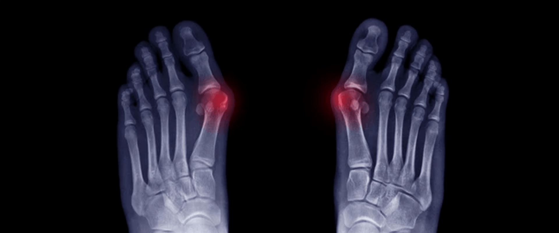Hammer Toes: What They Are, Why They Hurt, and How g-defy Shoes Can He ...